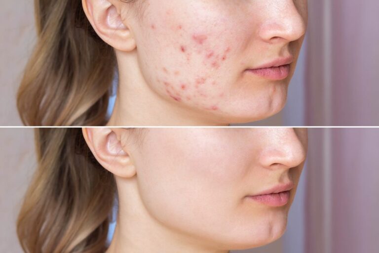 Acne Scar Treatment in Plano & Frisco, Texas | Le Beau Visage Med Spa